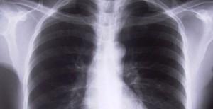 Edema Pulmonar - Sintomas, Causas e Tratamento